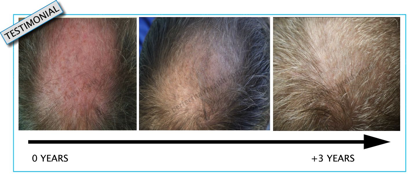 Evidence-Based Approaches To Stopping And Reversing Hair Loss